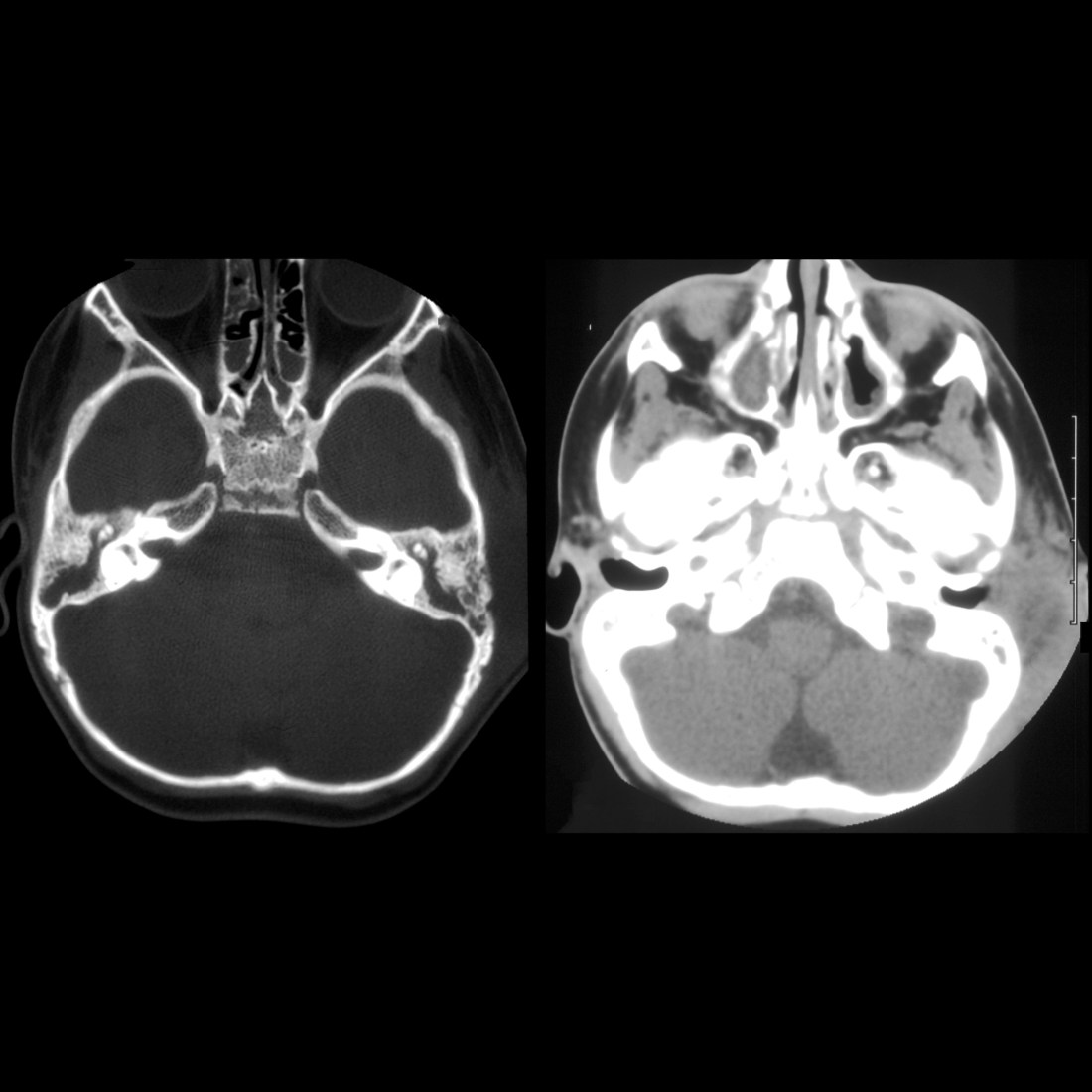 Pediatric Acute Mastoiditis | Pediatric Radiology Reference Article ...