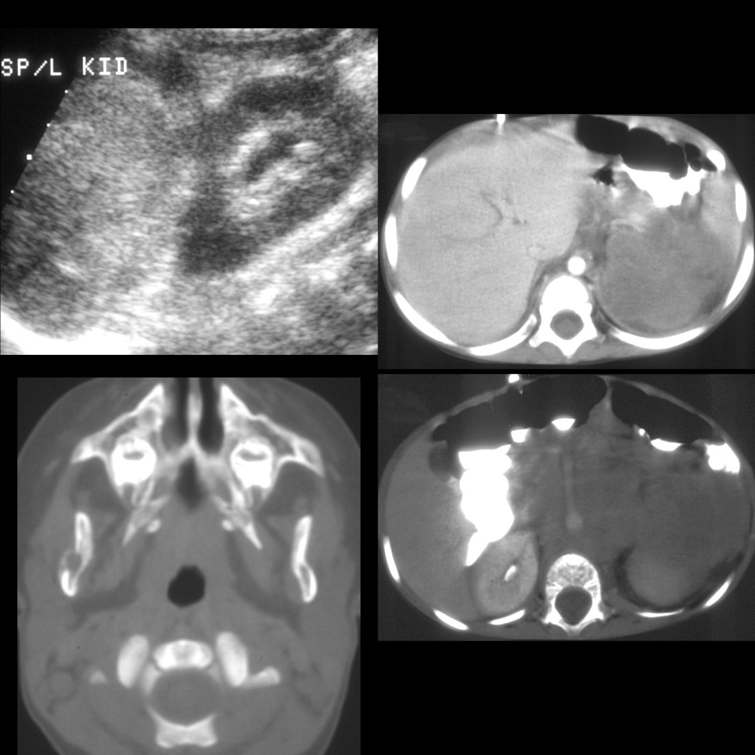 Pediatric Bone Metastasis | Pediatric Radiology Reference Article ...