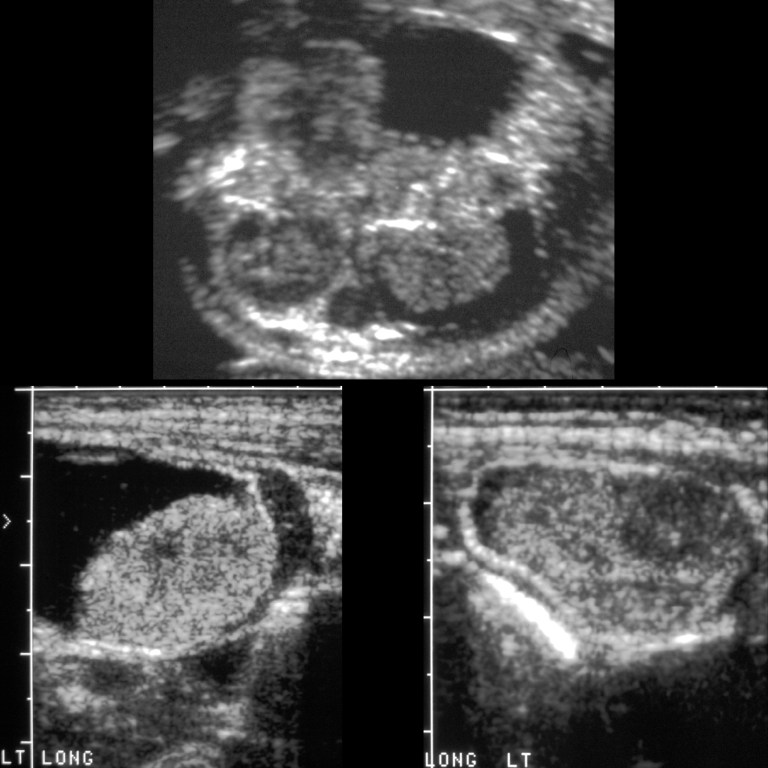 Neonatal Ovarian Cyst | Pediatric Radiology Reference Article ...
