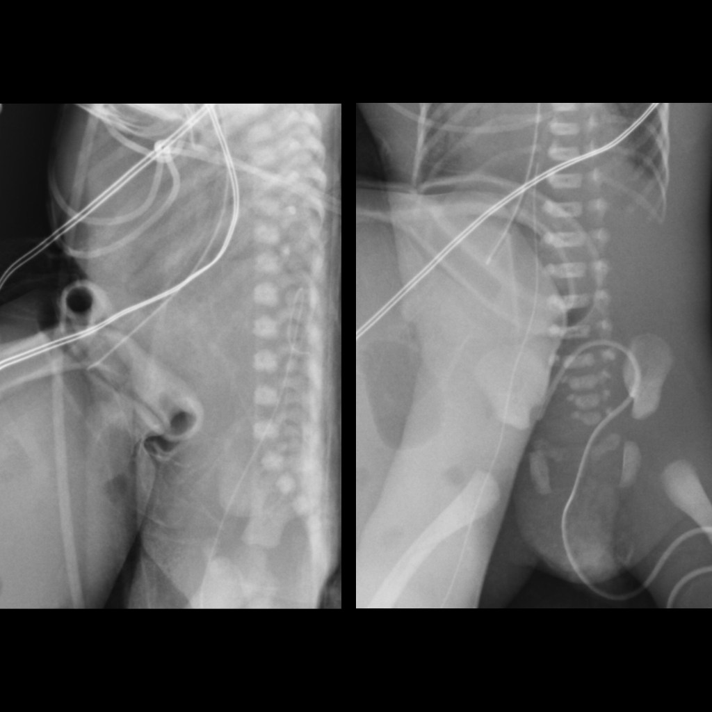 Omphalocele | Pediatric Radiology Reference Article | Pediatric Imaging ...