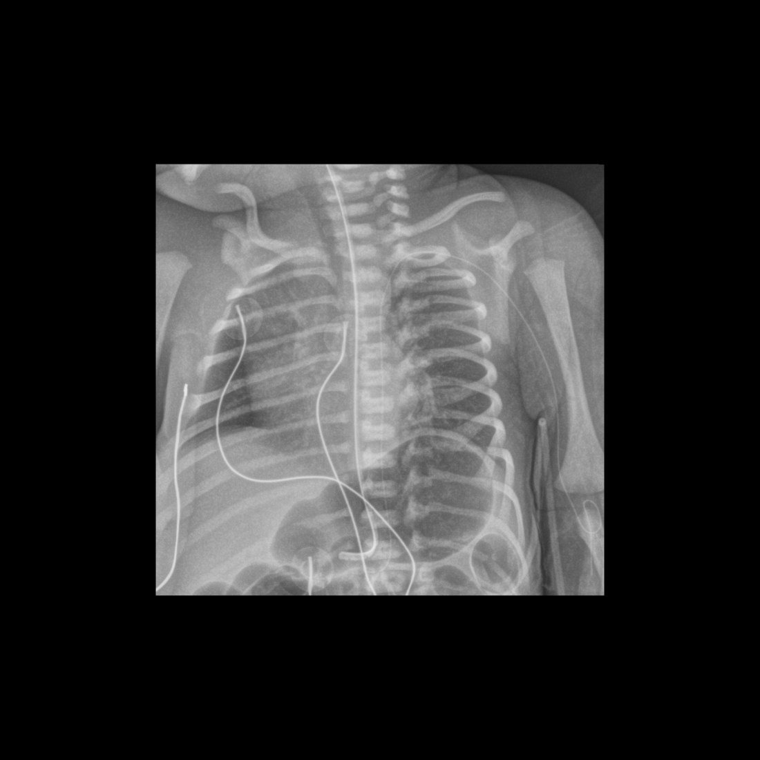 Premature newborn with a new PICC line | Pediatric Radiology Case ...