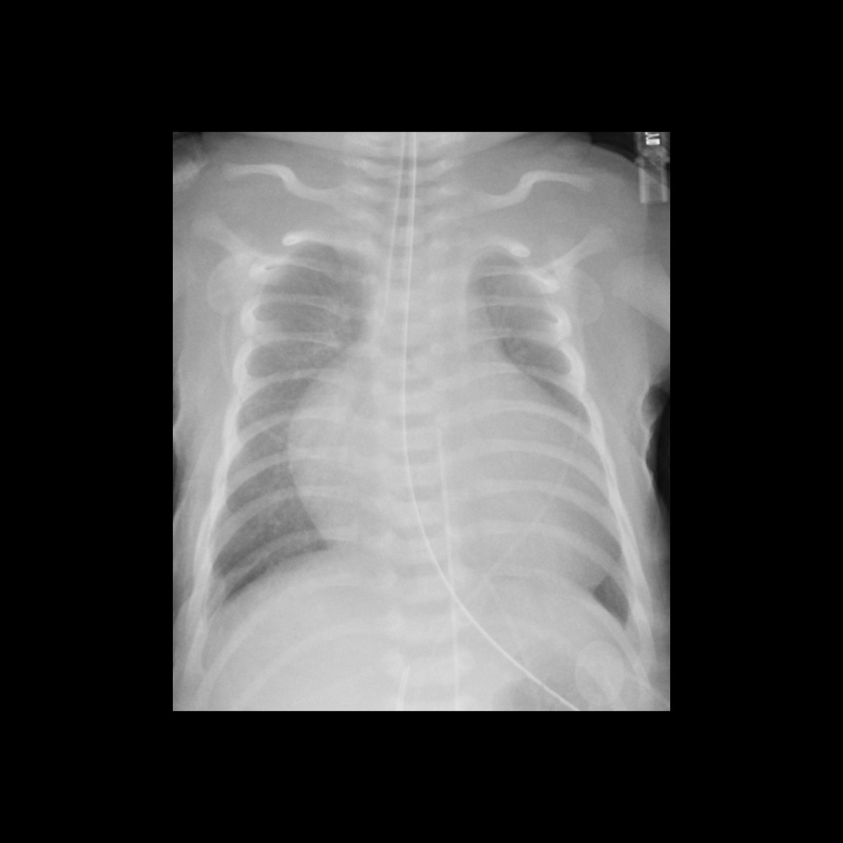 Newborn with cyanosis | Pediatric Radiology Case | Pediatric Imaging ...