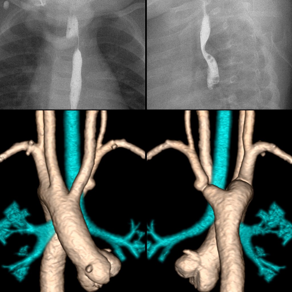 Pediatric Right Aortic Arch With Aberrant Left Subclavian Artery ...