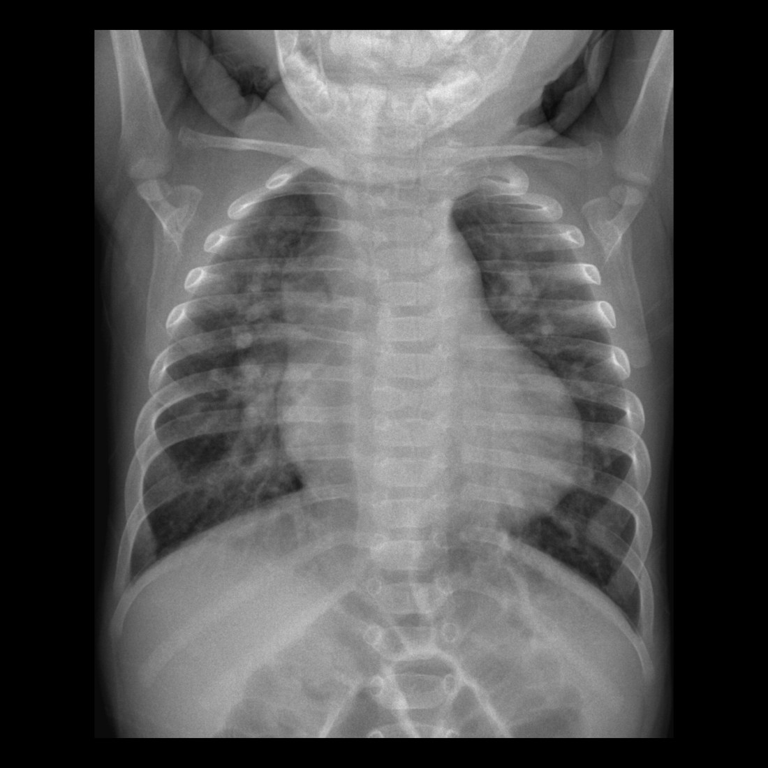 Infant with cough and fever and a murmur | Pediatric Radiology Case ...