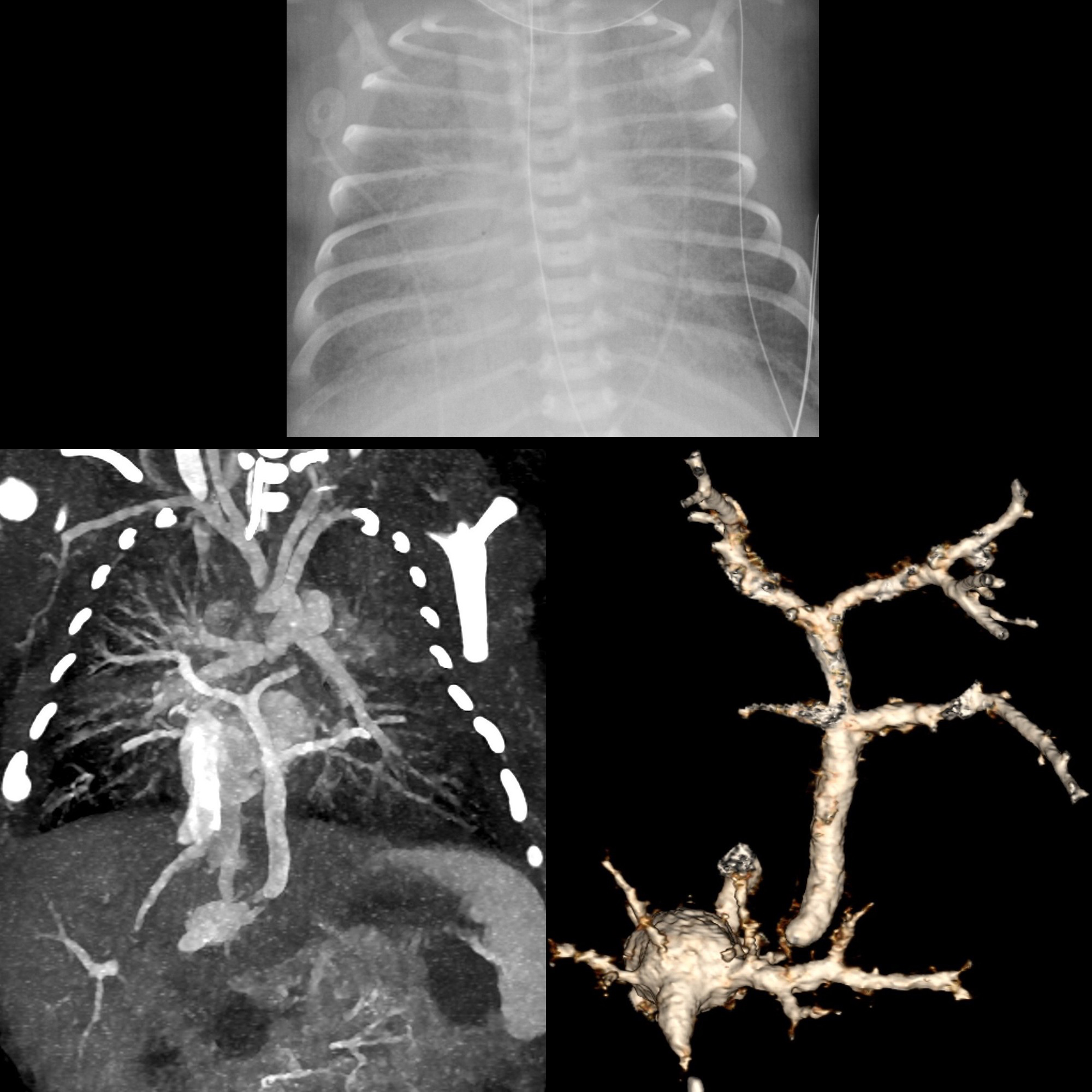 TotalAnomalousPulmonaryVenousReturn01MDInfracardiacPulmonaryVeinsFromBo ...