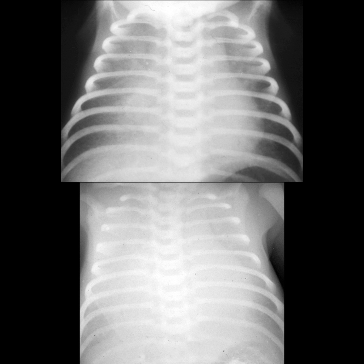 Newborn with cyanosis | Pediatric Radiology Case | Pediatric Imaging ...