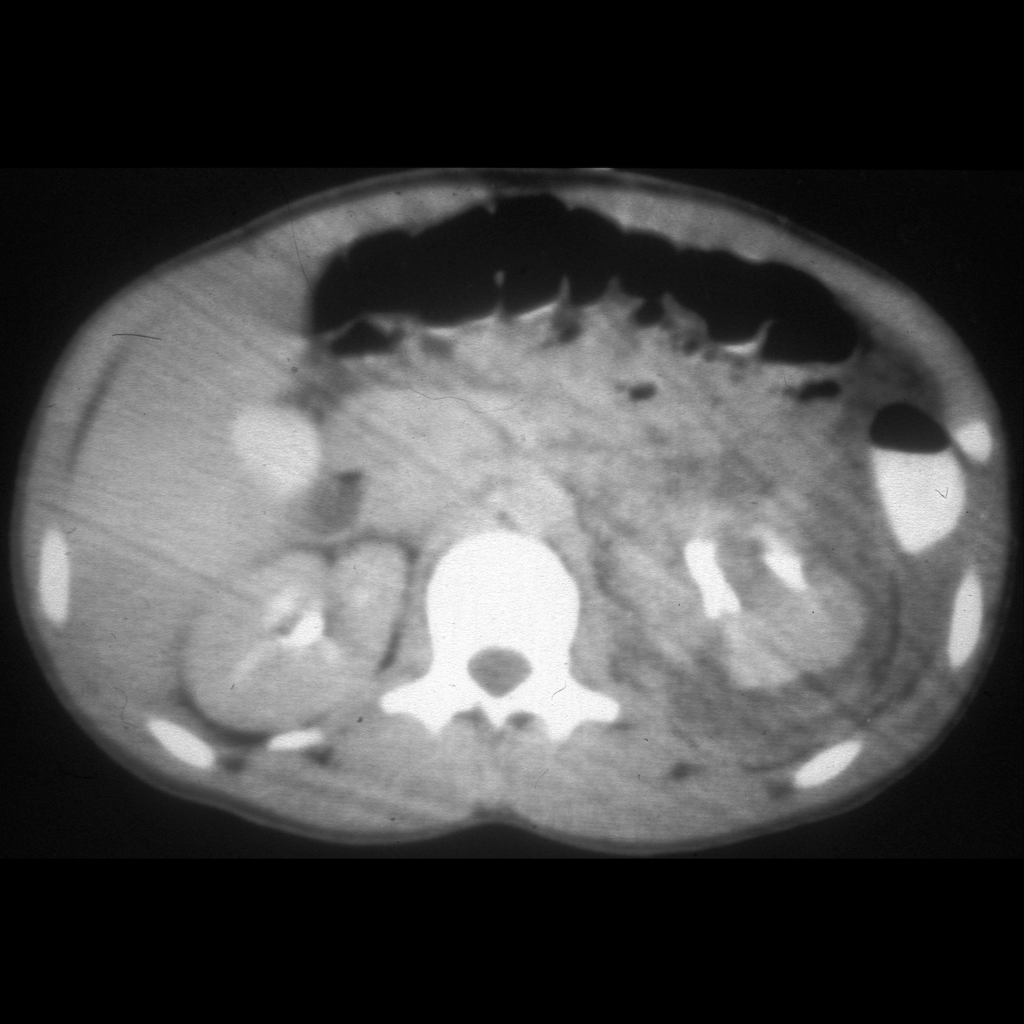 Pediatric Renal Trauma | Pediatric Radiology Reference Article ...