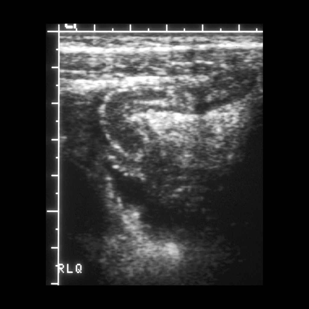 Pediatric Appendicitis | Pediatric Radiology Reference Article ...