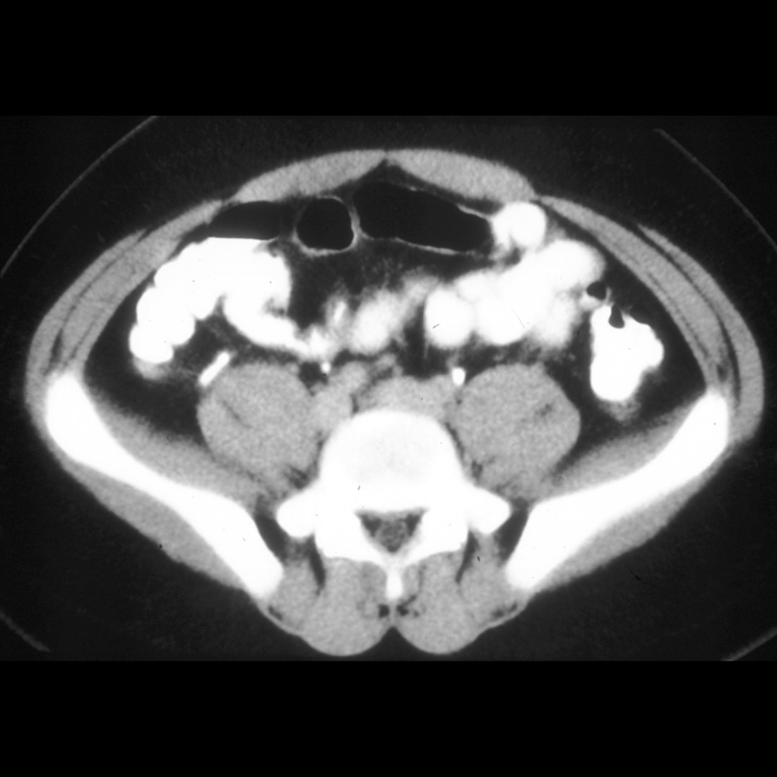 Pediatric Appendicitis | Pediatric Radiology Reference Article ...