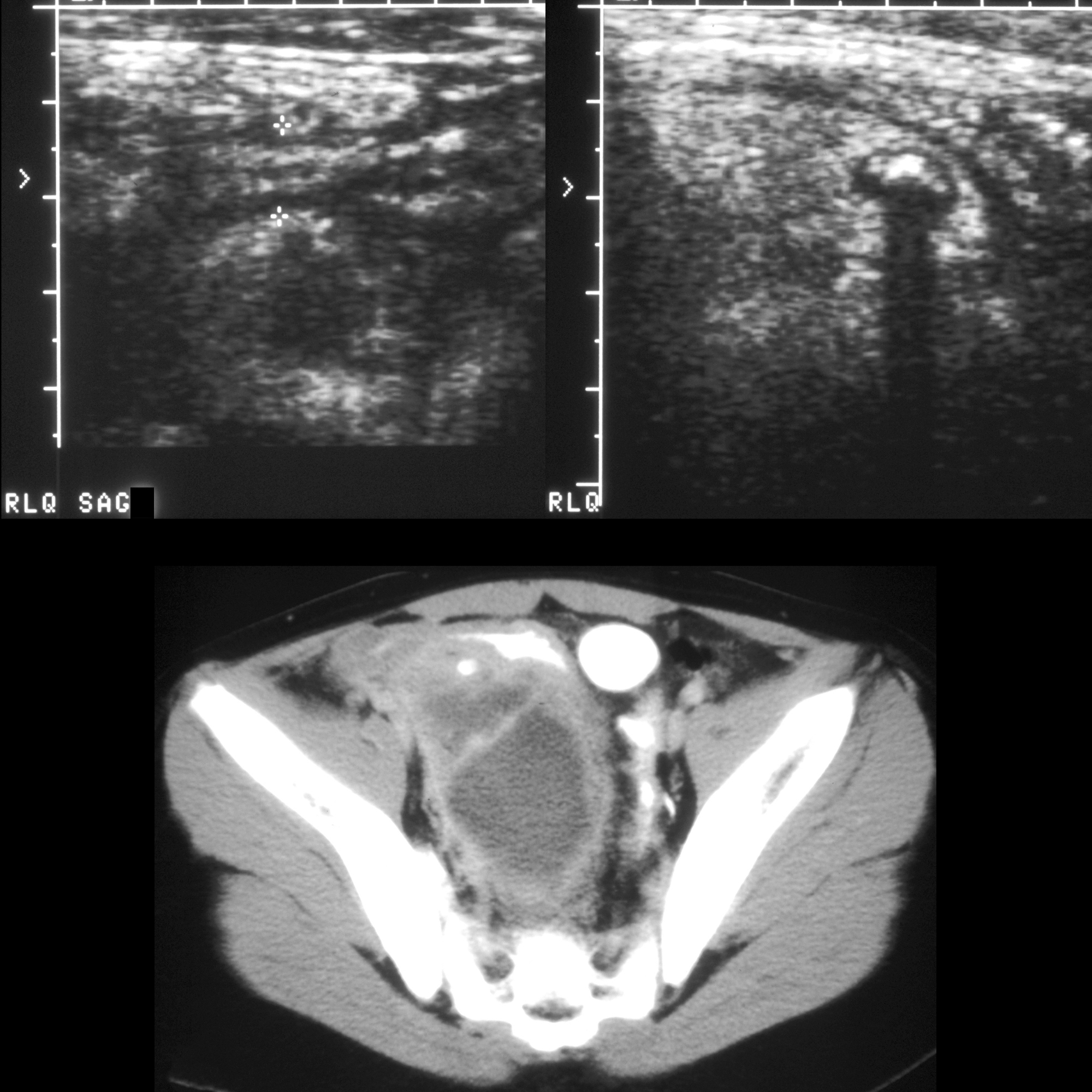 Pediatric Appendicitis | Pediatric Radiology Reference Article ...