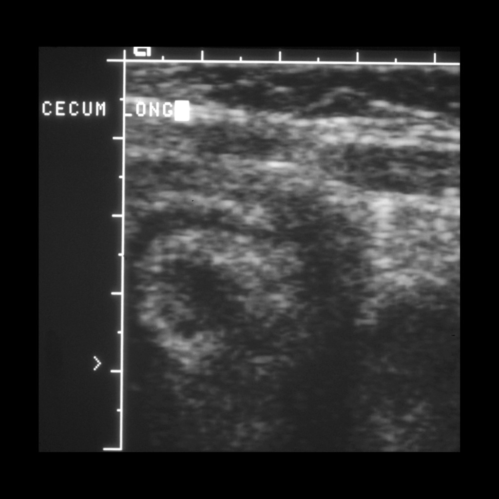 Pediatric Infectious Colitis | Pediatric Radiology Reference Article ...