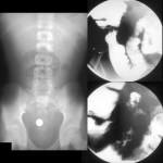 Pediatric Small Bowel Obstruction | Pediatric Radiology Reference ...