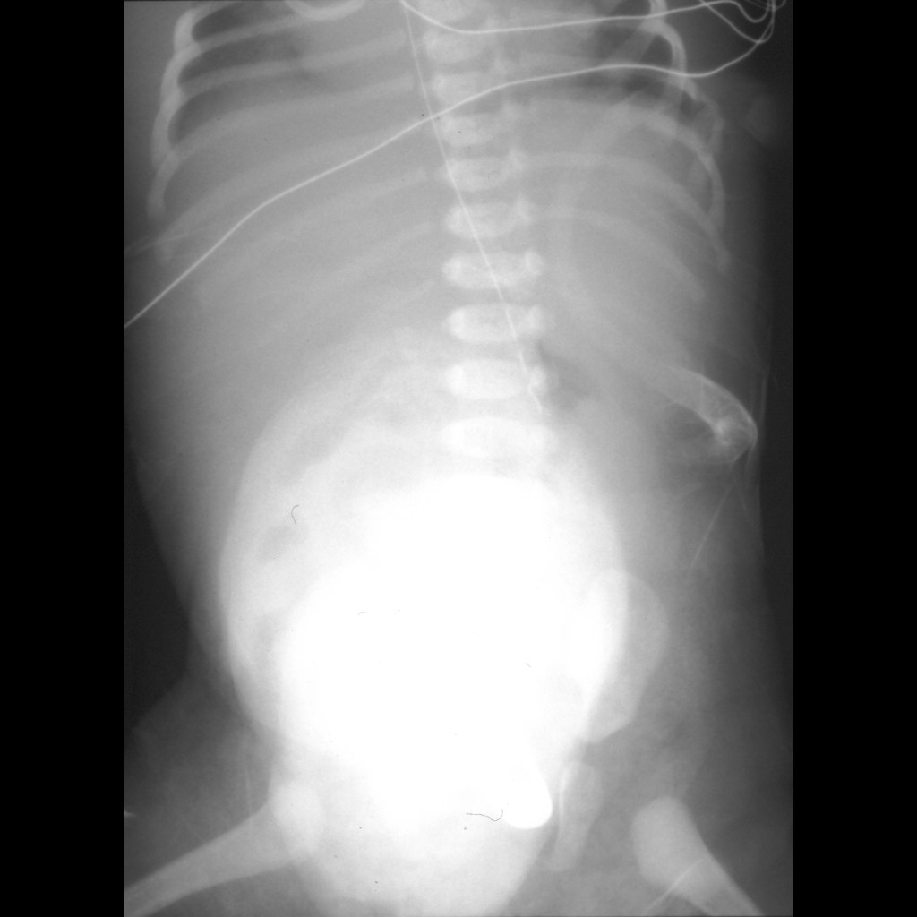 Gastroschisis | Pediatric Radiology Reference Article | Pediatric ...