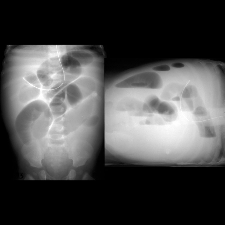 Ileocolic Intussusception | Pediatric Radiology Reference Article ...