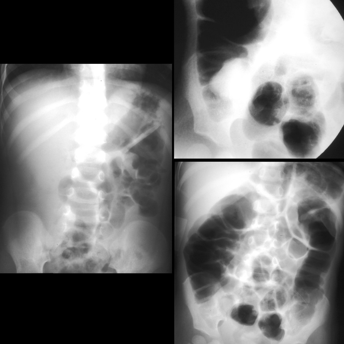 Ileocolic Intussusception | Pediatric Radiology Reference Article ...