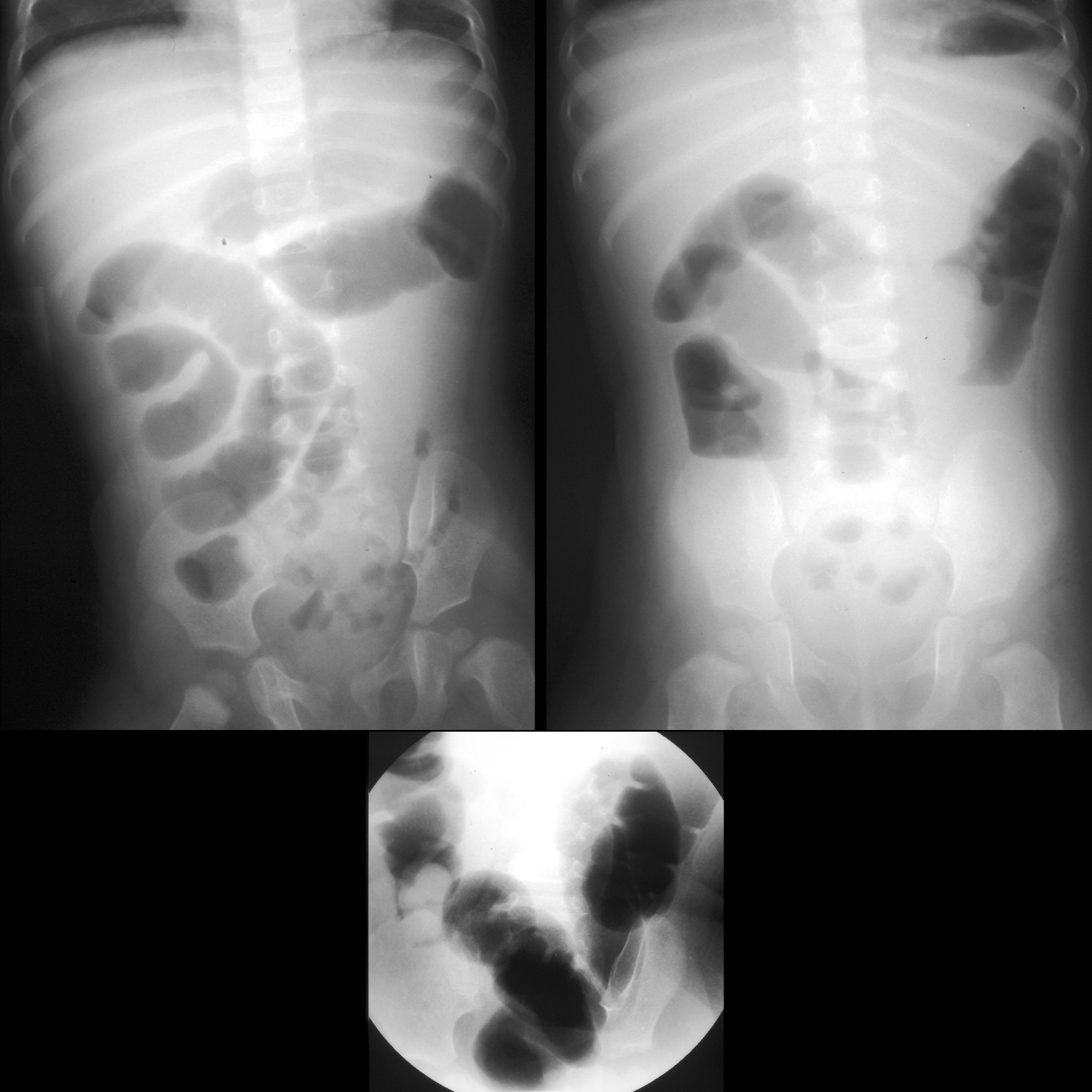 Ileocolic Intussusception | Pediatric Radiology Reference Article ...