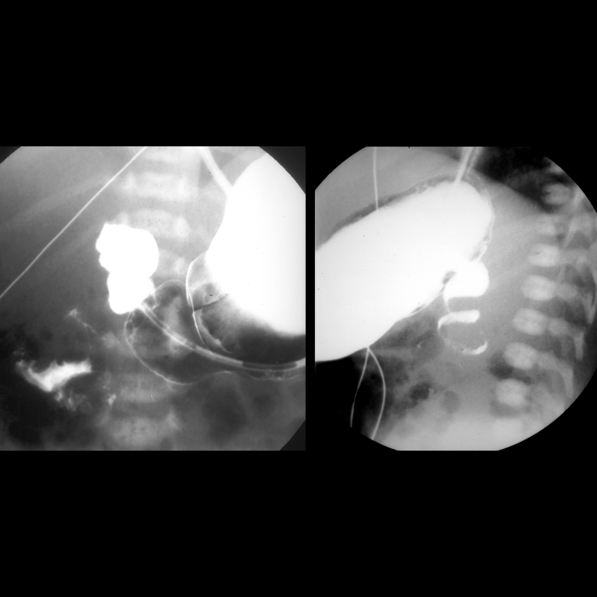 Newborn with bilious emesis | Pediatric Radiology Case | Pediatric ...