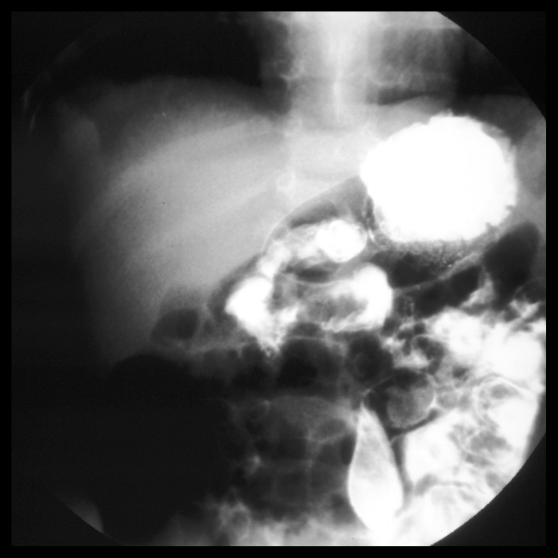 Malrotation With Midgut Volvulus | Pediatric Radiology Reference ...