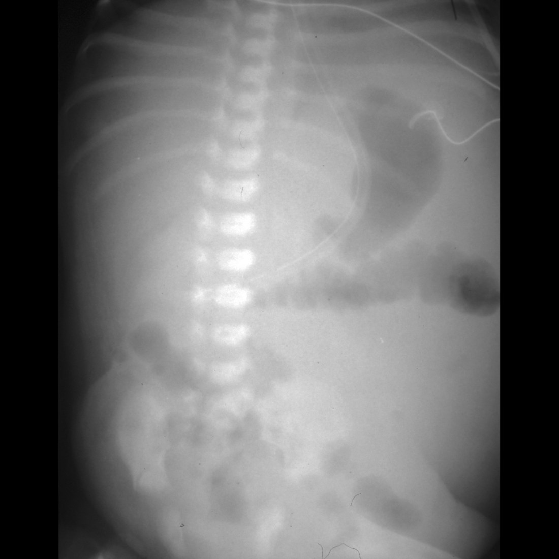 Malrotation With Midgut Volvulus | Pediatric Radiology Reference ...