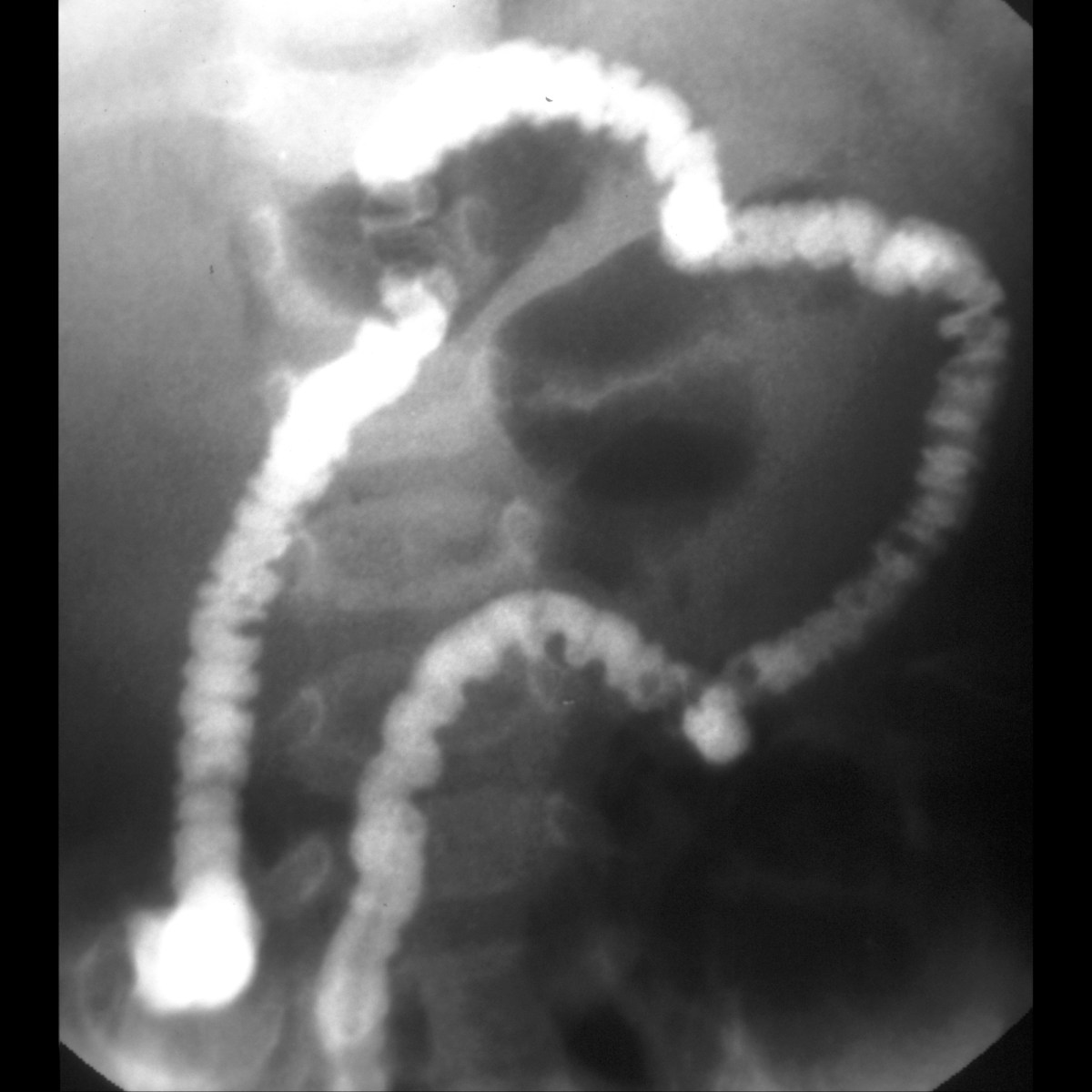 Infant with cecal perforation just after birth status post diverting ...