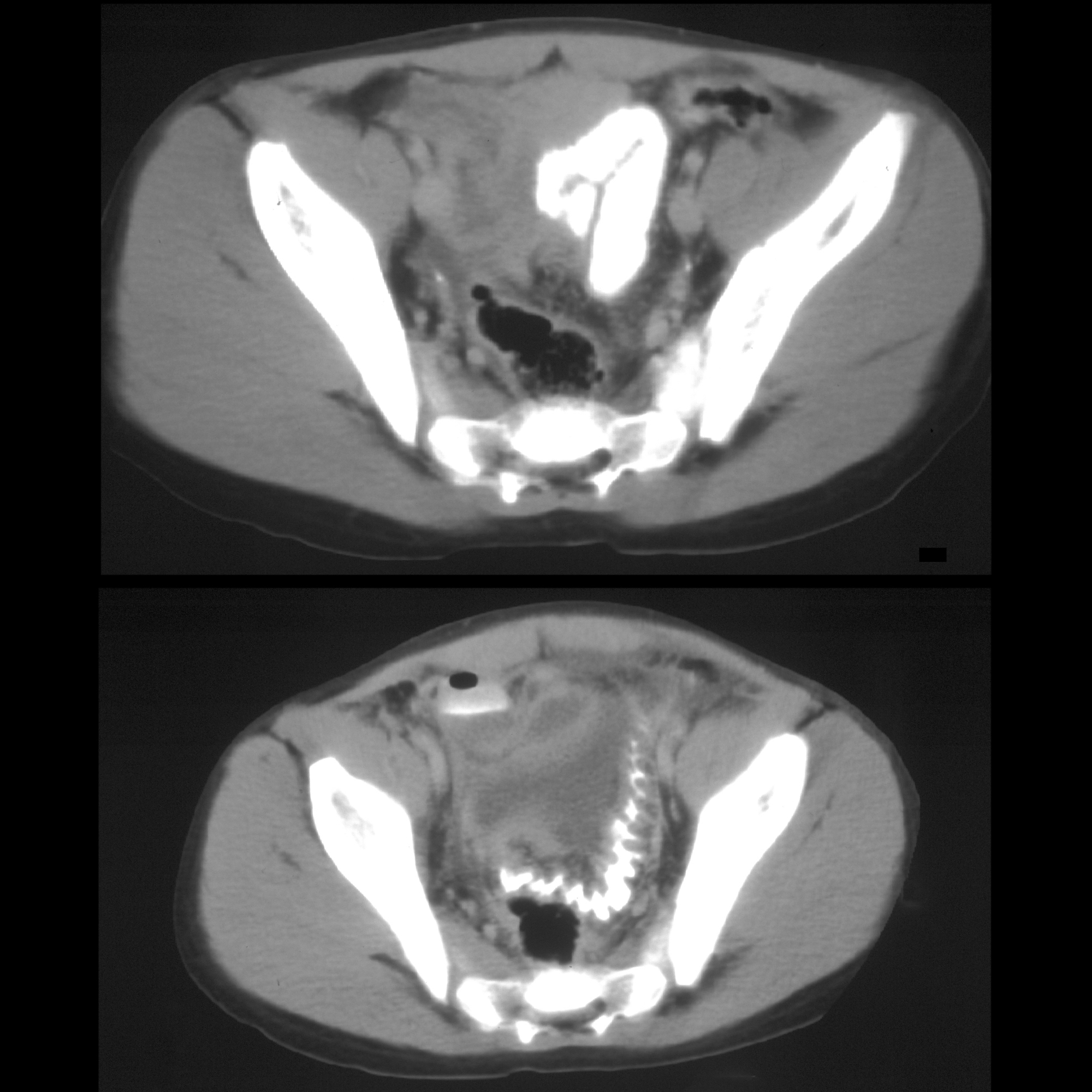 Pediatric Bowel Trauma | Pediatric Radiology Reference Article ...