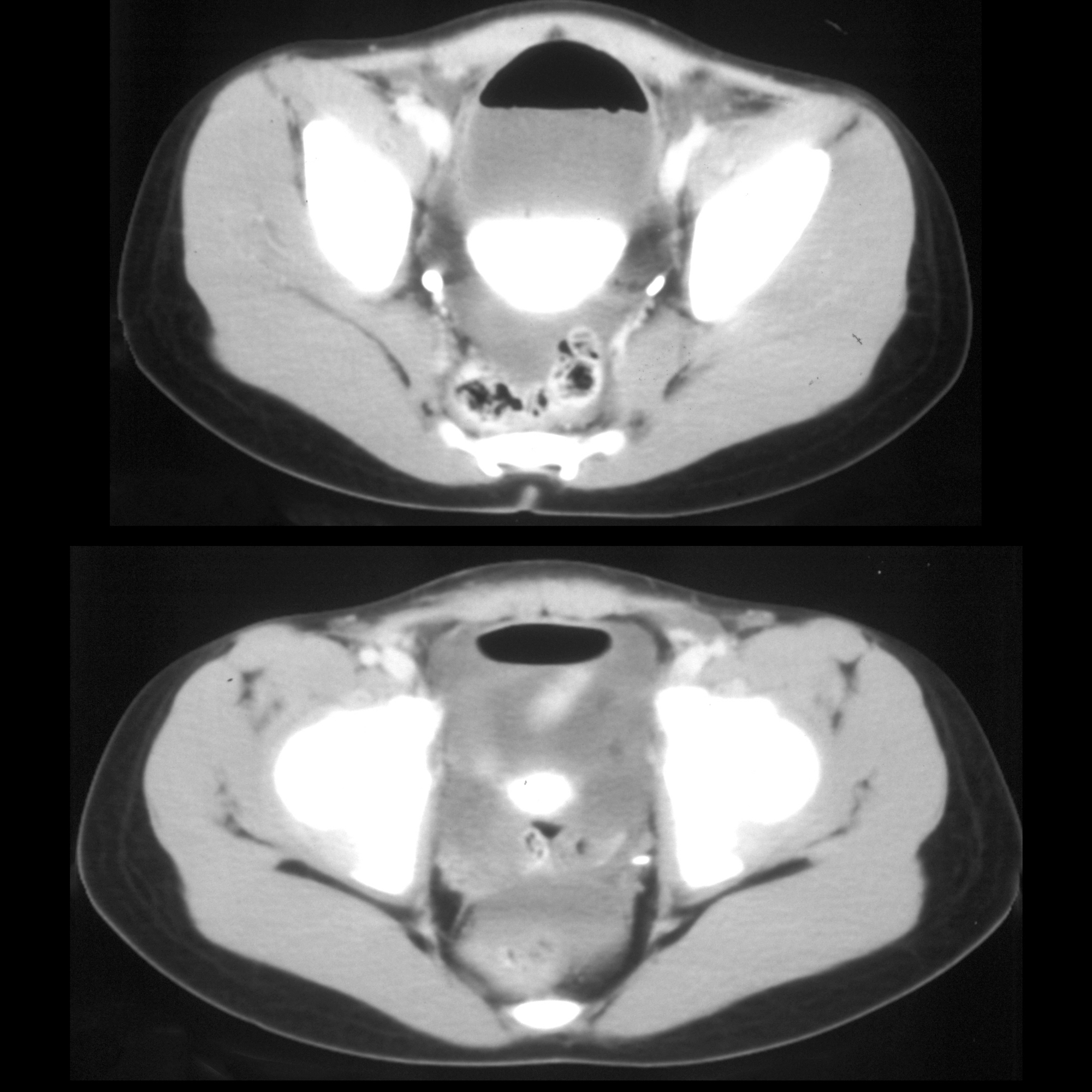 Pediatric Bowel Trauma | Pediatric Radiology Reference Article ...