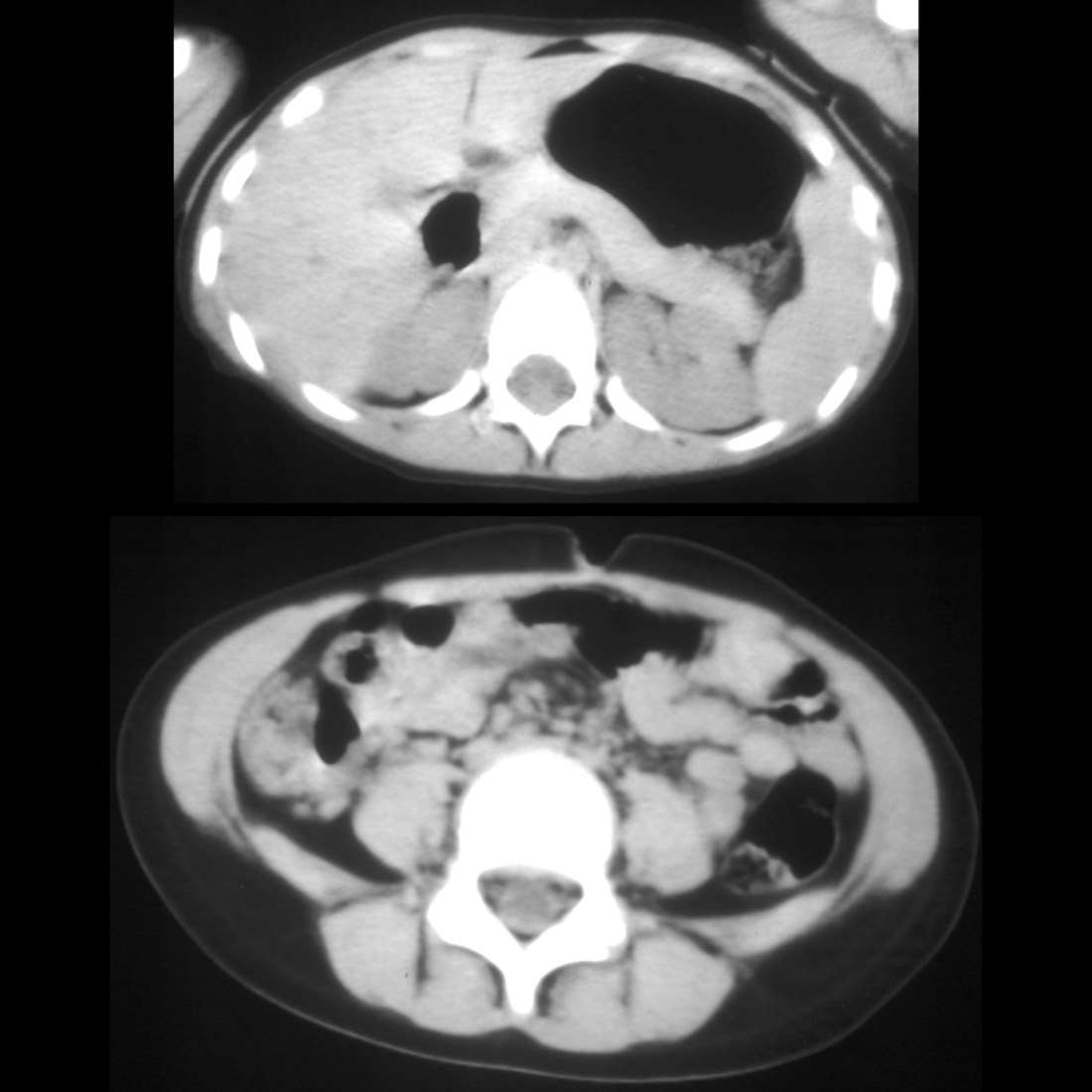 Pediatric Splenic Trauma | Pediatric Radiology Reference Article ...