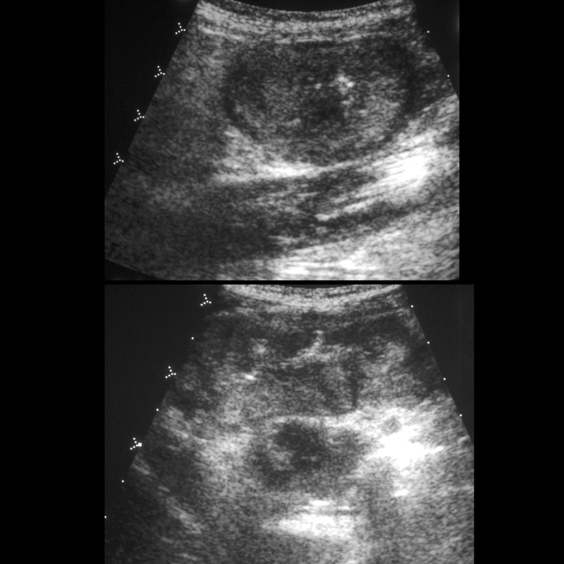 Pediatric Typhlitis | Pediatric Radiology Reference Article | Pediatric ...