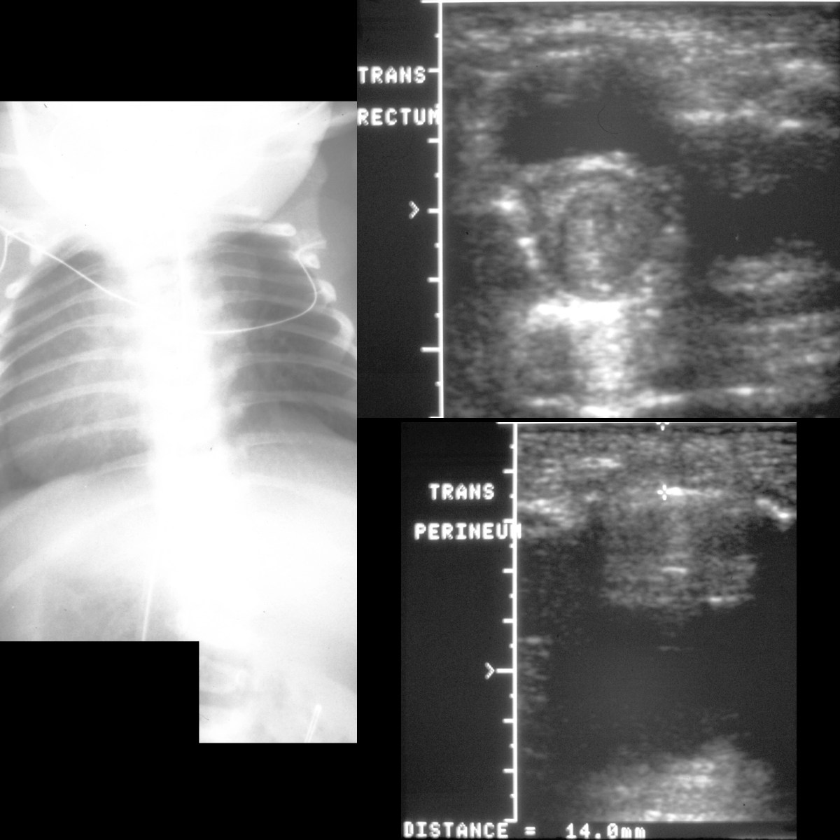Newborn with absent anus and stool coming out of the vagina | Pediatric ...