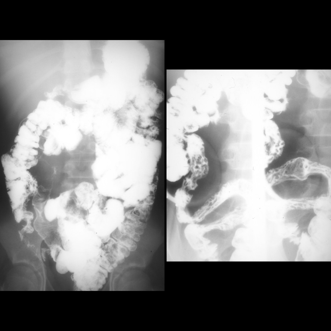 Pediatric Crohn Disease | Pediatric Radiology Reference Article ...