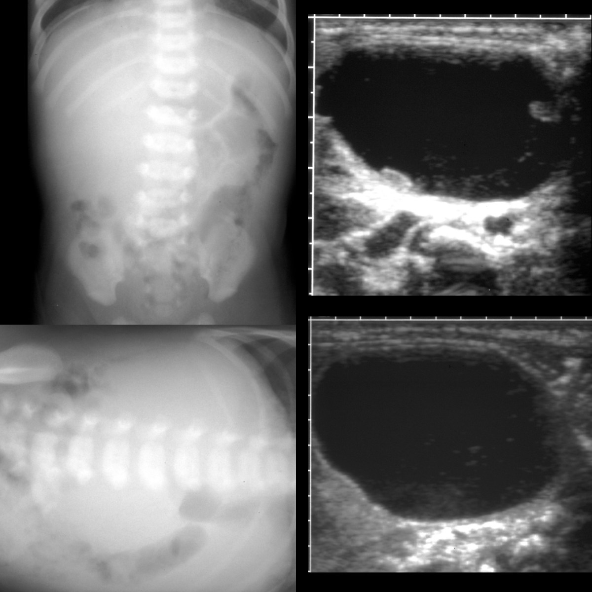 Newborn with a palpable abdominal mass | Pediatric Radiology Case ...