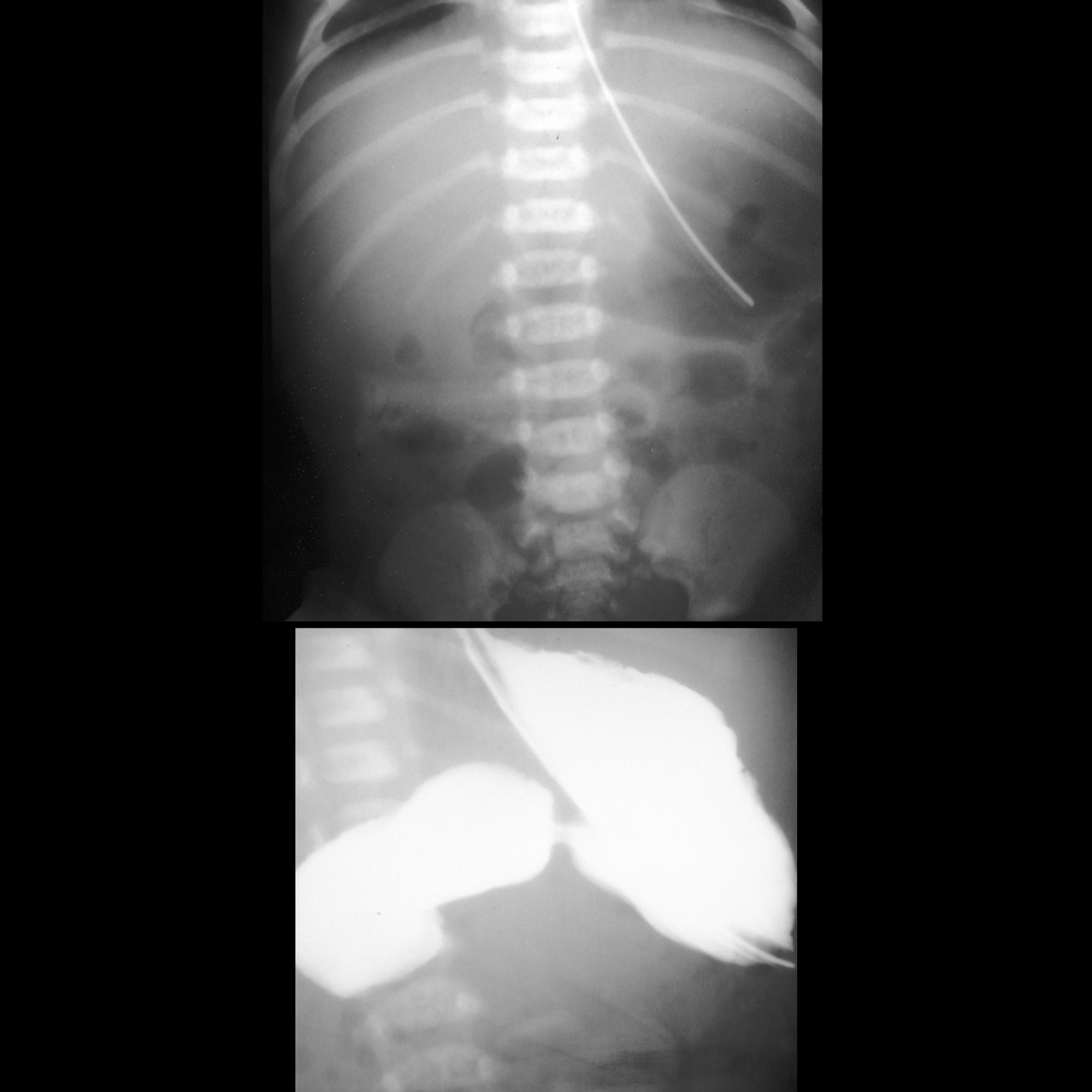 Pediatric Duodenal Stenosis | Pediatric Radiology Reference Article ...