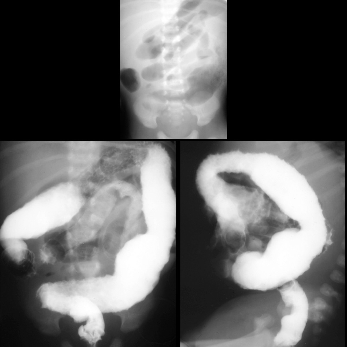 Infant with decreased stool output and fever | Pediatric Radiology Case ...