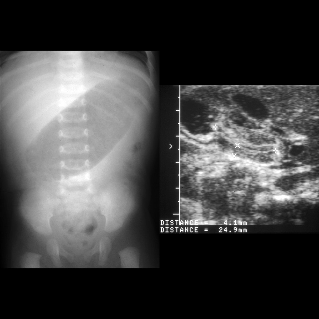 Infantile Hypertrophic Pyloric Stenosis Image Radiopaediaorg