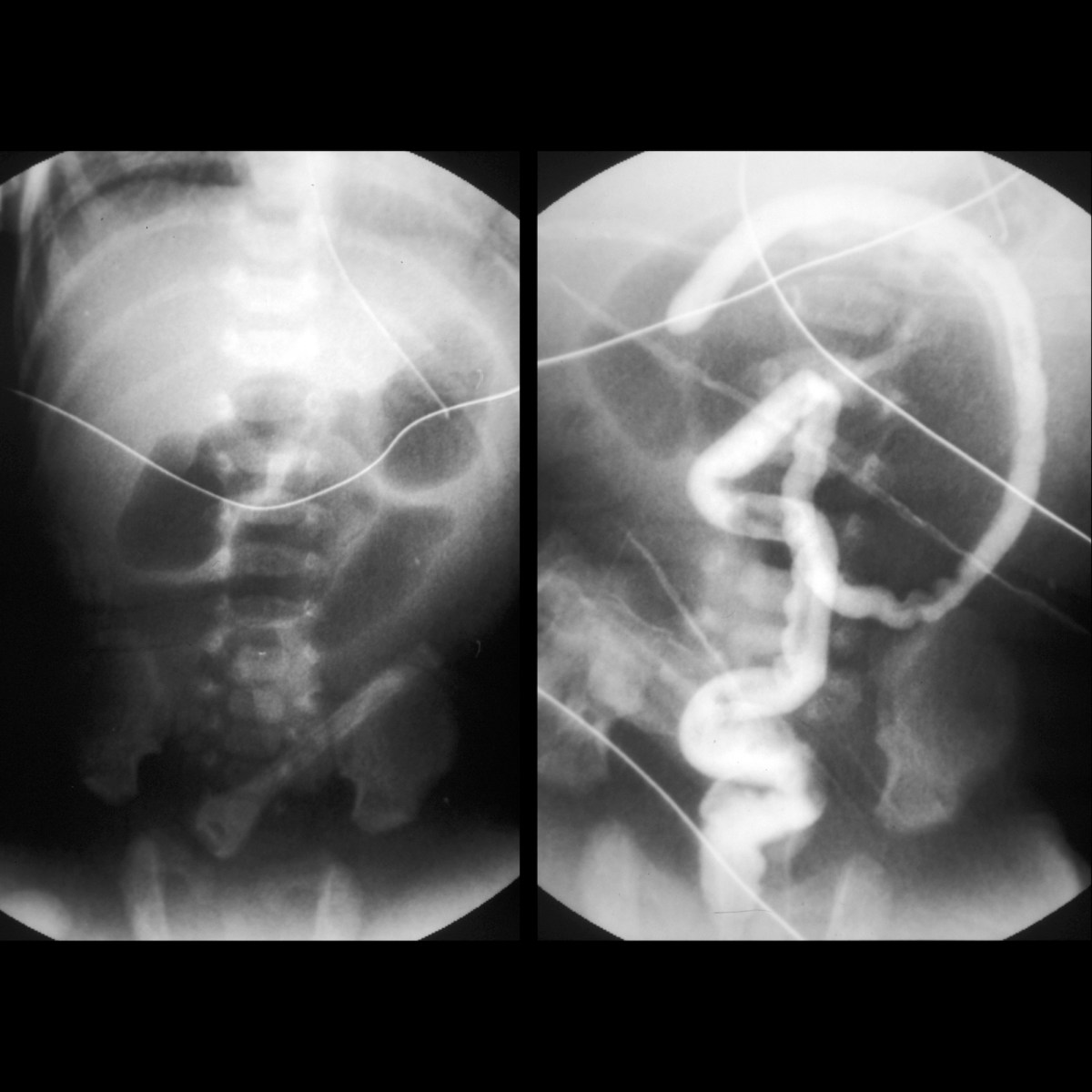 Newborn who is vomiting with feeds | Pediatric Radiology Case ...