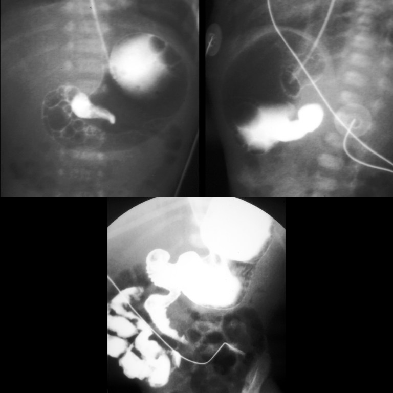 Malrotation With Midgut Volvulus | Pediatric Radiology Reference ...