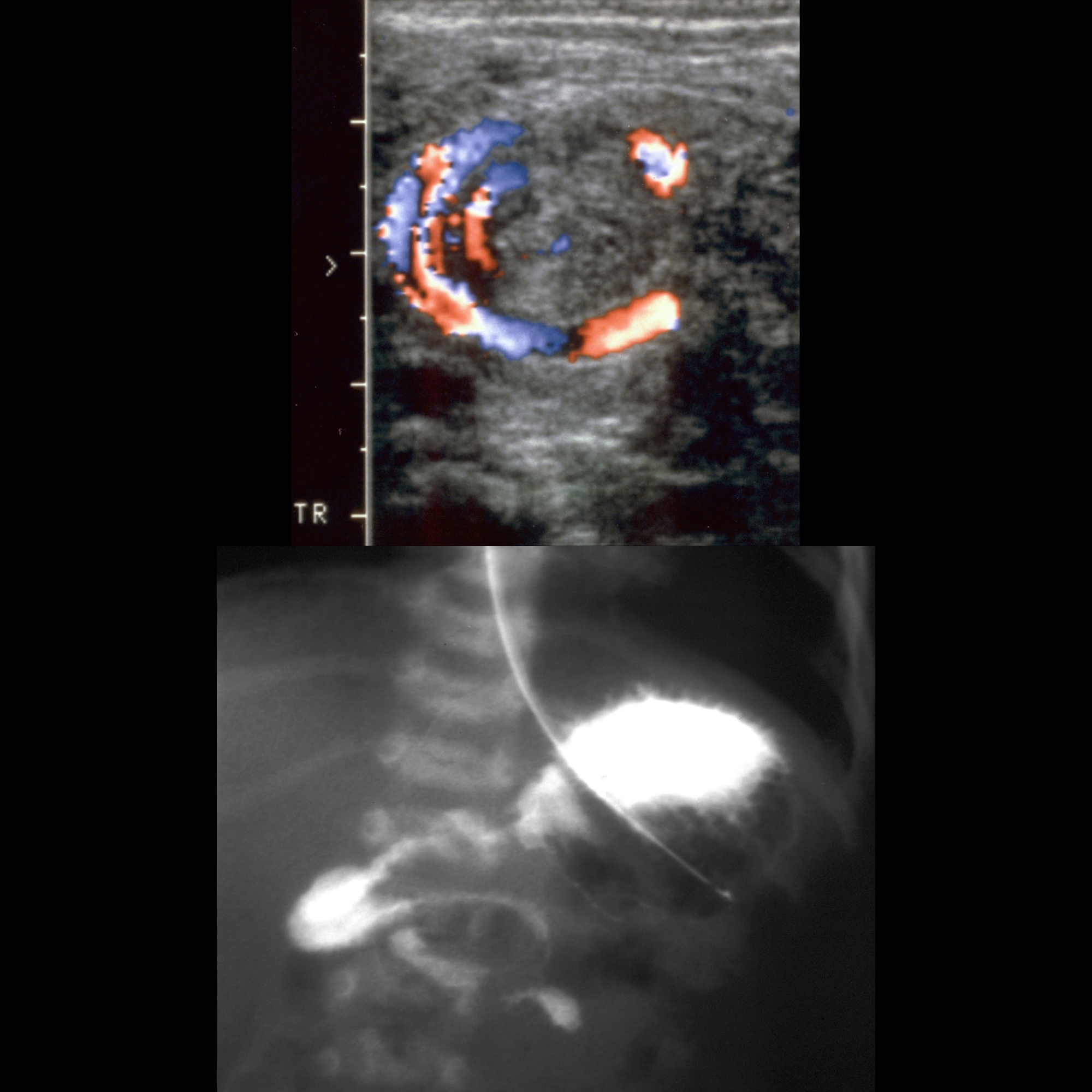 Infant with projectile vomiting | Pediatric Radiology Case | Pediatric ...
