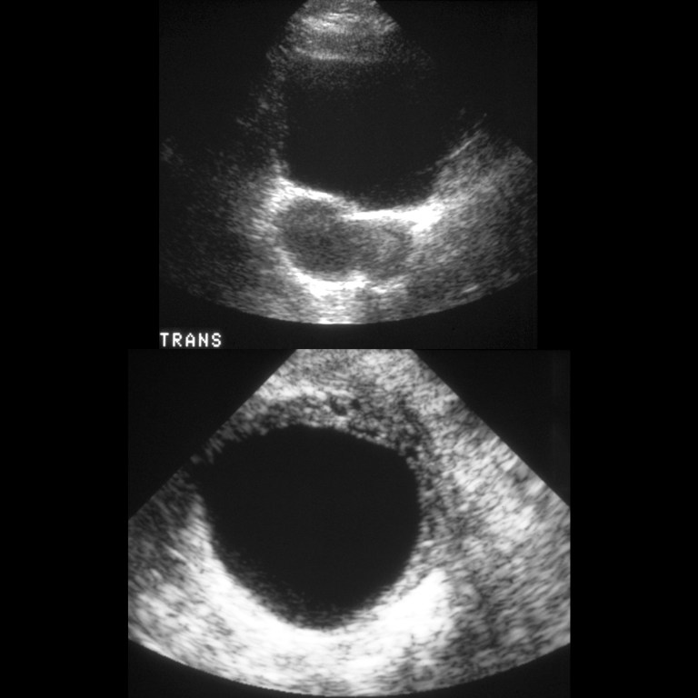 Female teenager with right lower quadrant pain, normal WBC and a ...