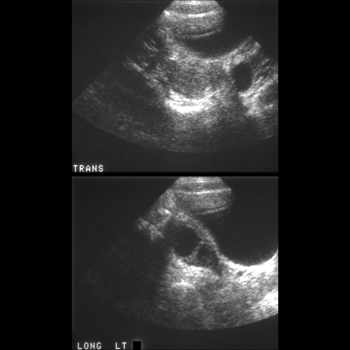 Female teenager with pelvic pain, normal WBC and a negative pregnancy ...