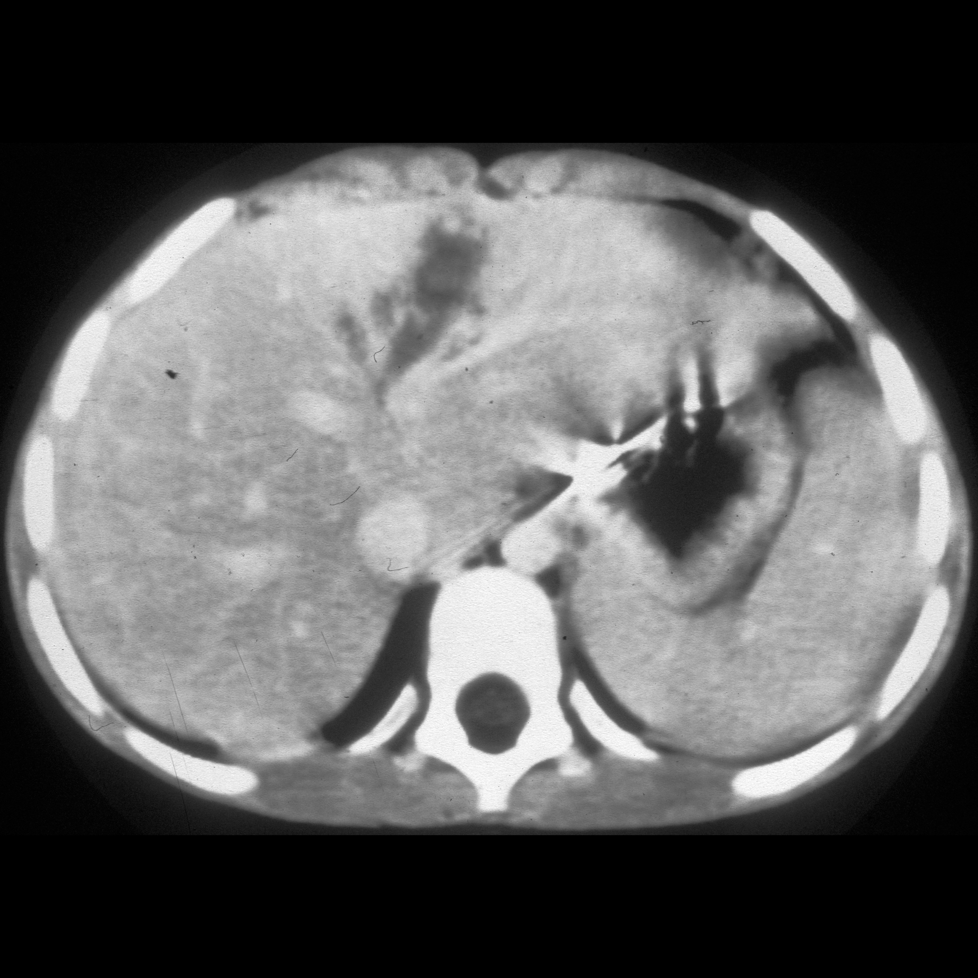 Pediatric Liver Trauma | Pediatric Radiology Reference Article ...