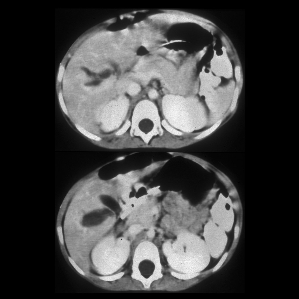 Pediatric Liver Trauma | Pediatric Radiology Reference Article ...