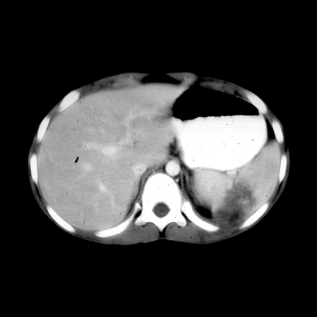 Pediatric Splenic Trauma | Pediatric Radiology Reference Article ...