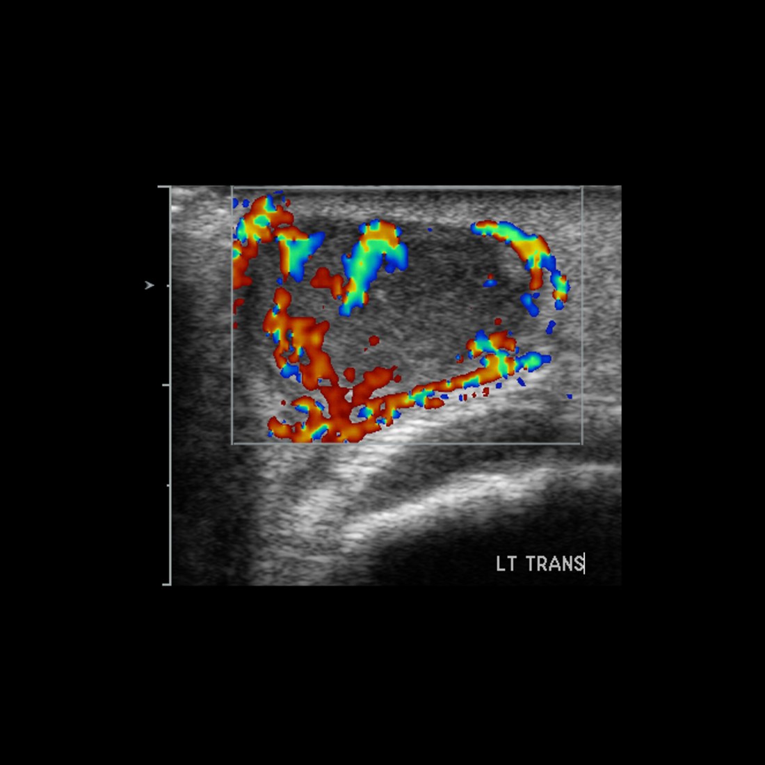 Pediatric Subcutaneous Abscess | Pediatric Radiology Reference Article ...