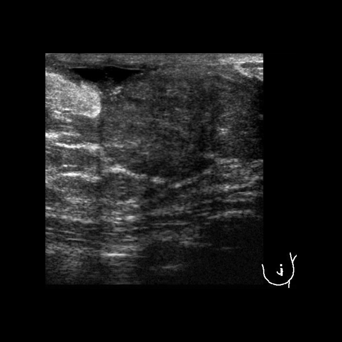 Pediatric Breast Abscess | Pediatric Radiology Reference Article ...