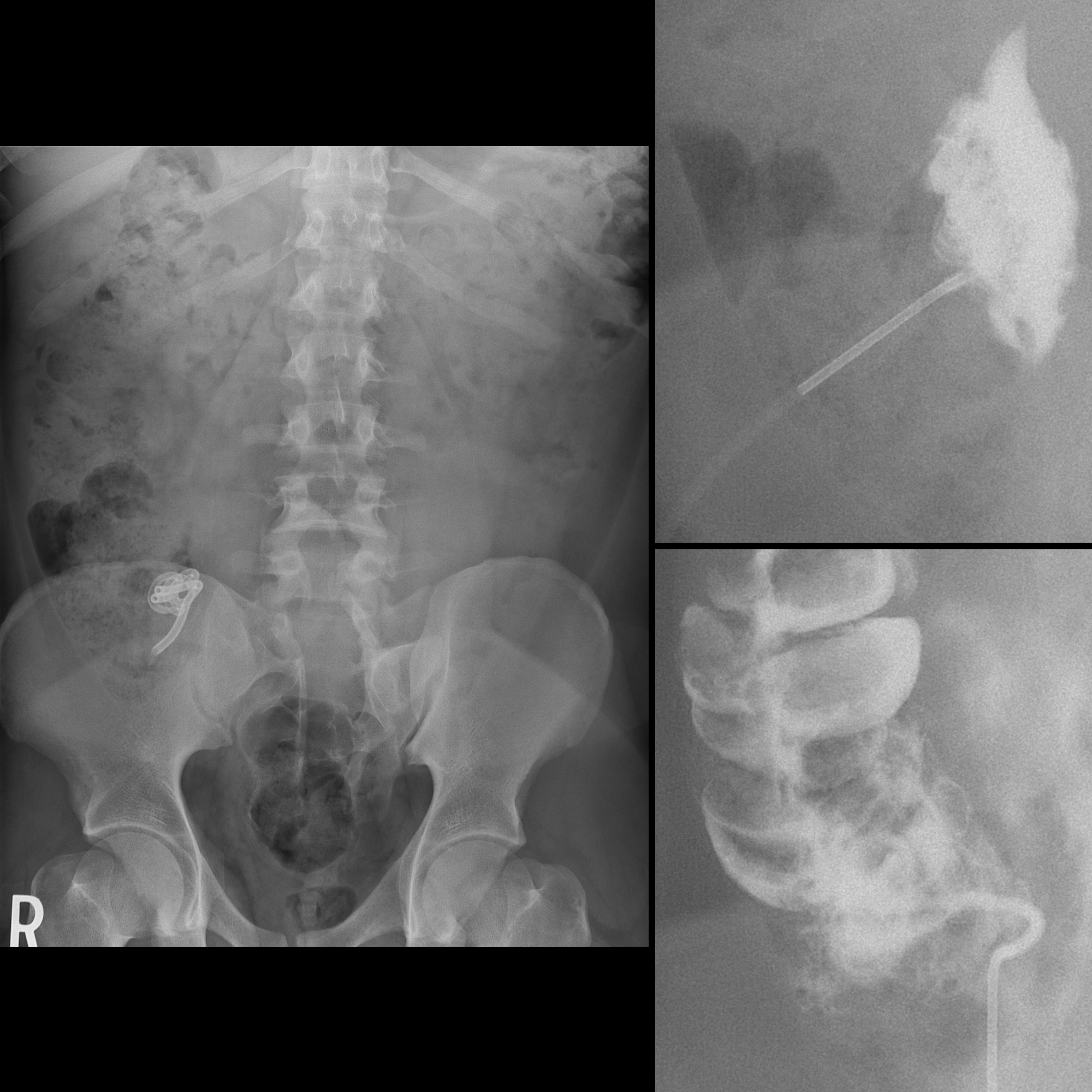Pediatric Cecostomy Tube Malfunction | Pediatric Radiology Reference ...