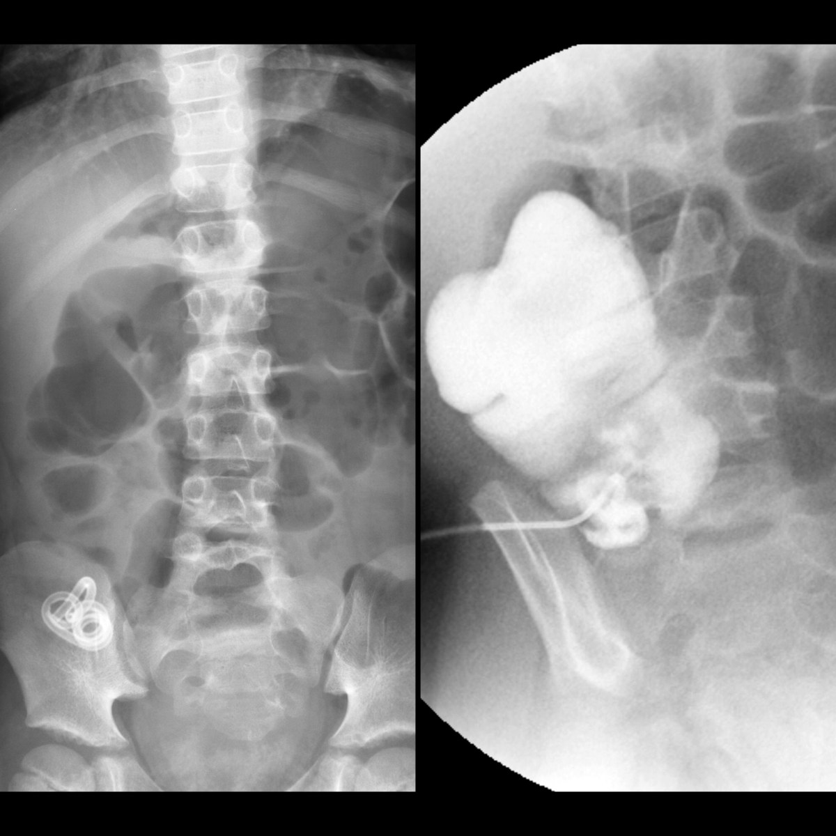 School ager who just had his cecostomy tube exchanged | Pediatric ...