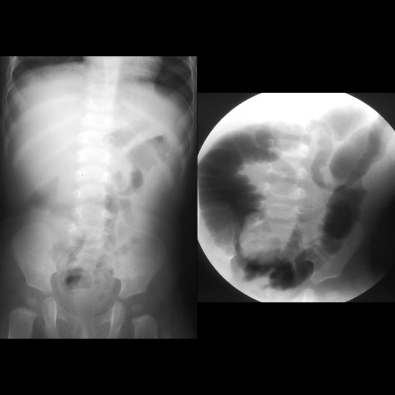 Ileocolic Intussusception | Pediatric Radiology Reference Article ...