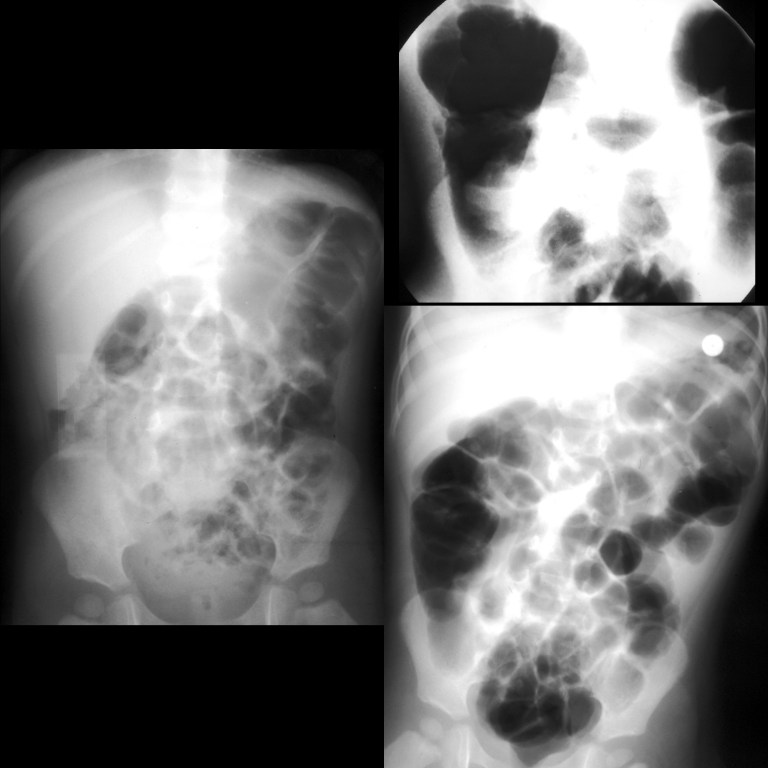 Ileocolic Intussusception | Pediatric Radiology Reference Article ...