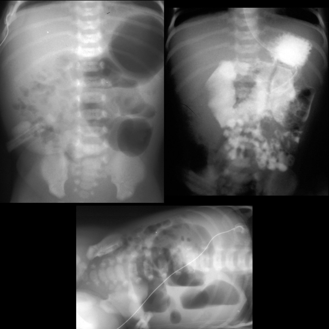 Newborn with polyhydramnios on prenatal US and bilious vomiting ...