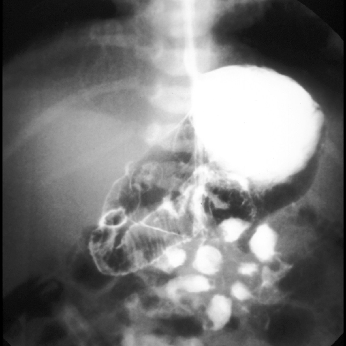 Infant with bilious vomiting | Pediatric Radiology Case | Pediatric ...
